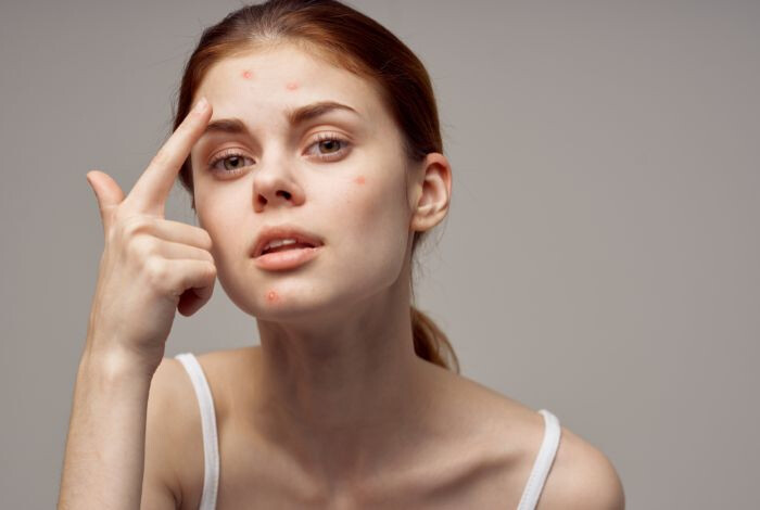 Understanding the Causes of Acne and How to Address Them Naturally ...